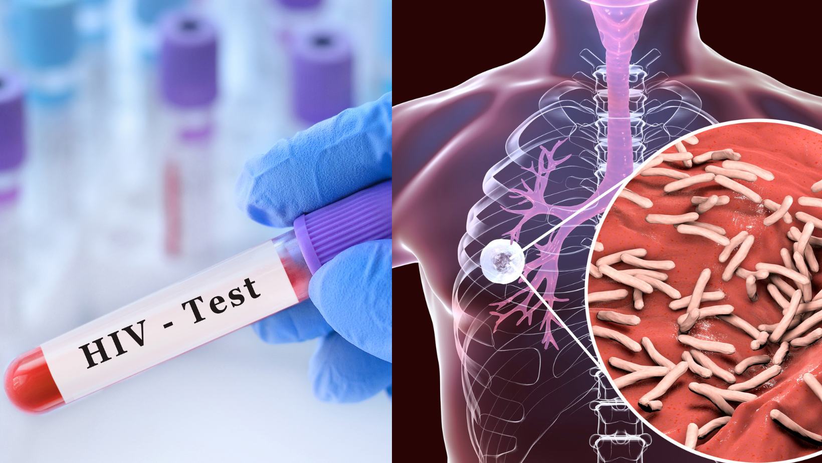 Quy định về tư vấn và xét nghiệm HIV cho người mắc bệnh lao phổi?